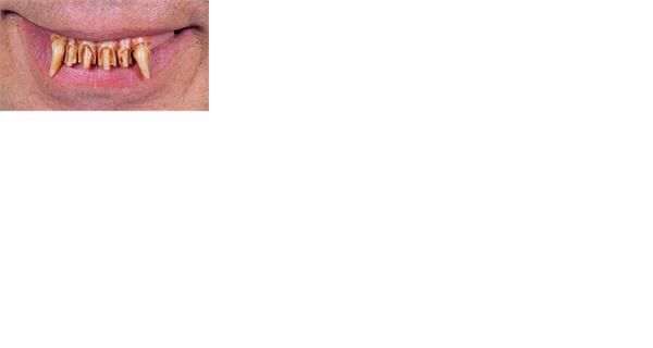 Werewolf Witch Chopper Teeth Adult Costume Accessory | Costumes.com.au ...